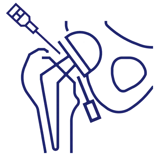 Hip Arthroscopy Procedure | Texas Ortho Associates