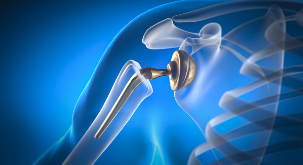 Anatomic vs. Reverse Shoulder Arthroplasty: Which Shoulder Replacement ...